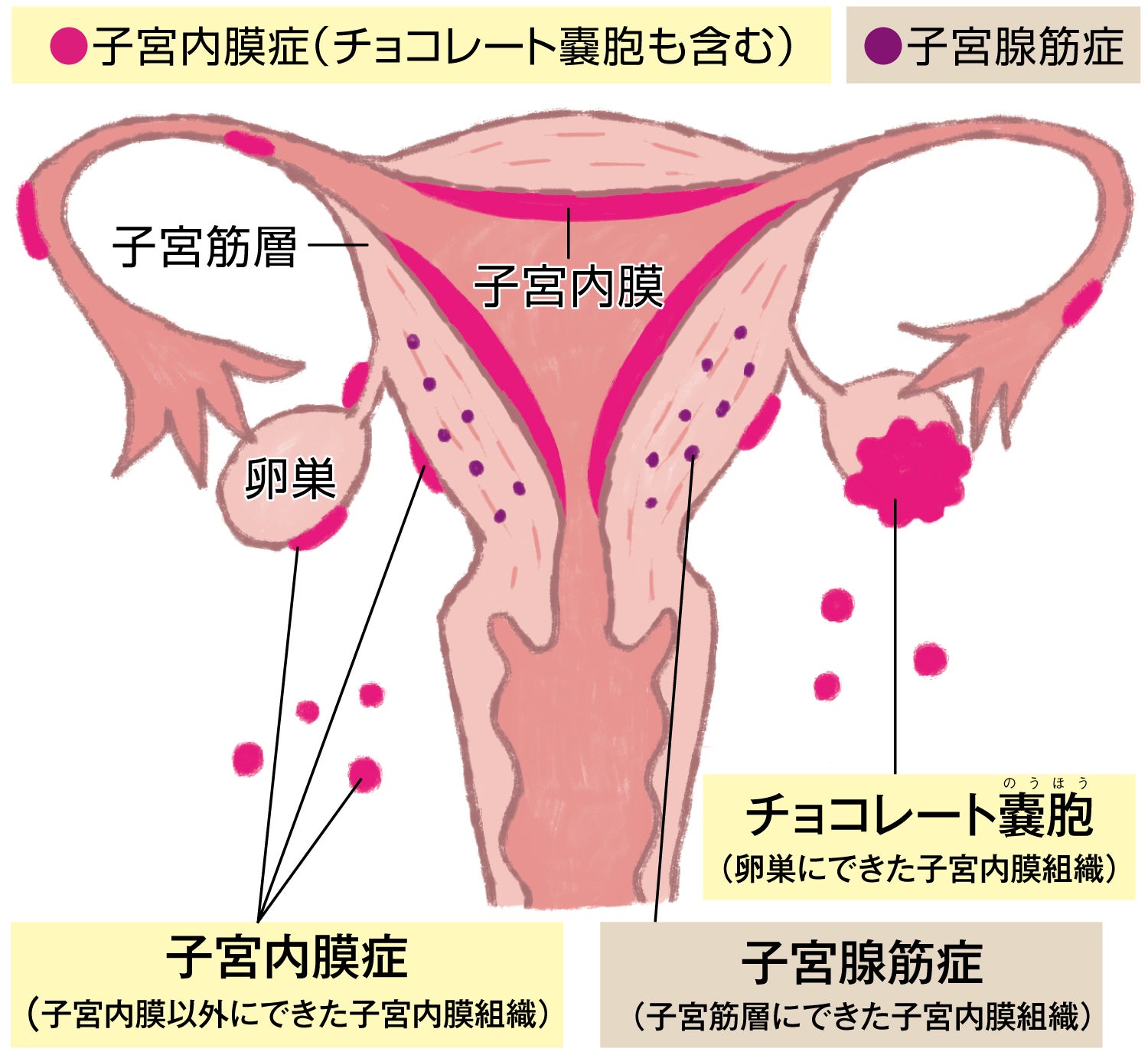 苦手だった子宮腺筋症あれこれ… 【大阪】 ジャパン・ヘルスサイエンス専門学院 Jhsc整体治療室 整体コラム 心のコラム
